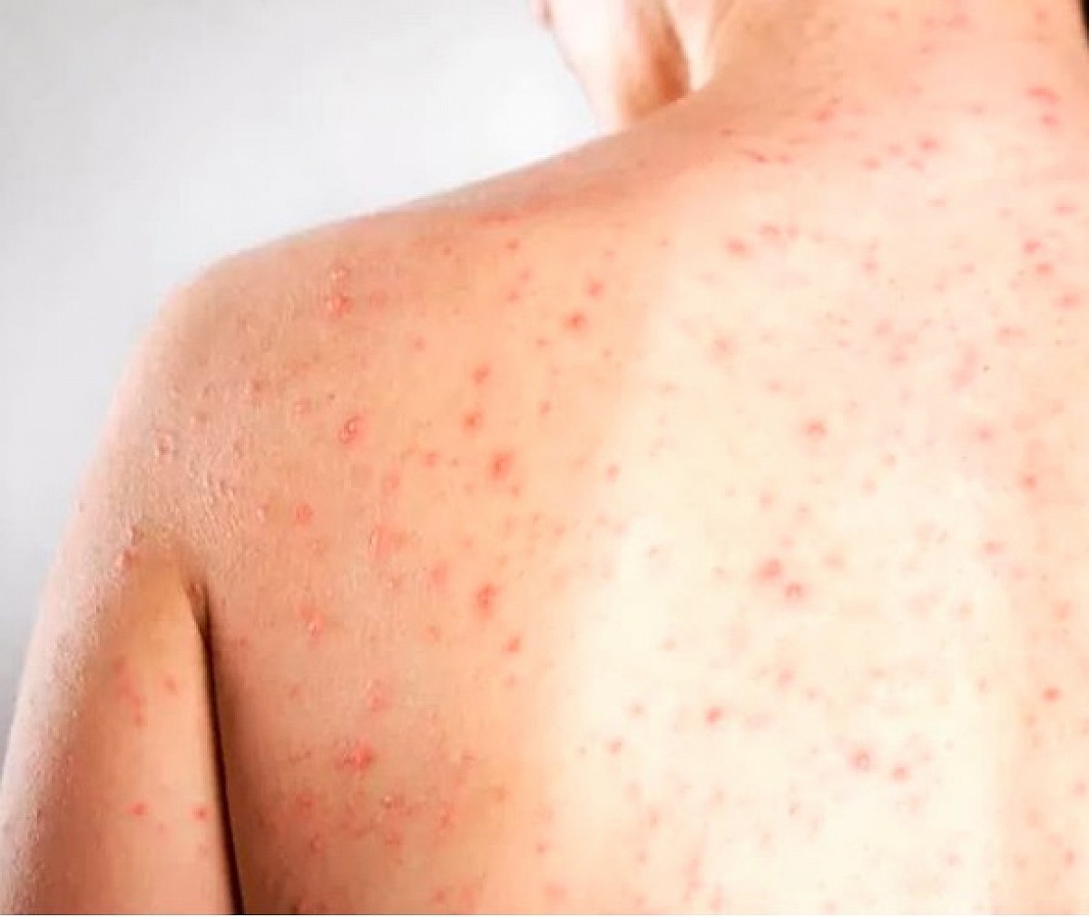 Sarampo – IME Clínica Cidadã | Blog